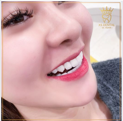 Răng sứ chuẩn Đức - chân răng trong suốt như răng thật