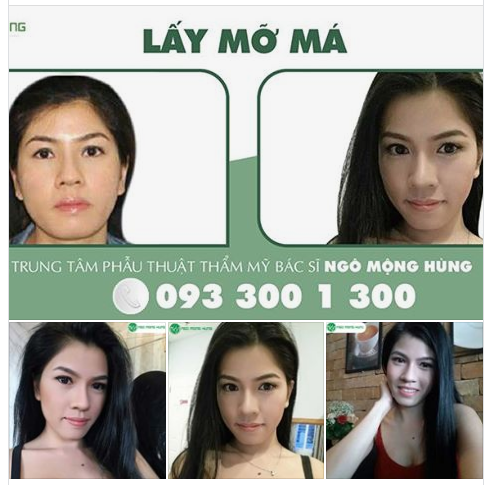 Mặt đẹp lai Tây – người người ngưỡng mộ sau thẩm mỹ lấy mỡ má.