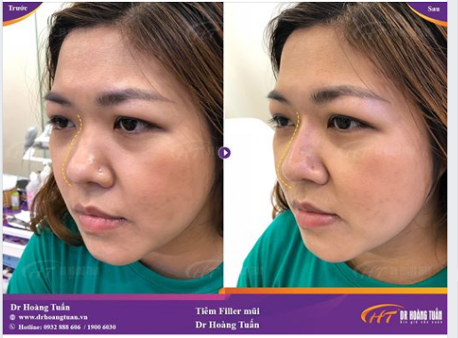 Dáng mũi gồ và sống mũi thấp đã được xử lý rất khéo léo với dịch vụ ...