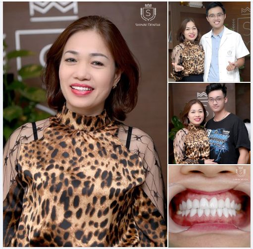 GHI ĐIỂM BẰNG NỤ CƯỜI CHUẨN CHẤT RIÊNG NHỜ FORM RĂNG ĐỘC NHẤT