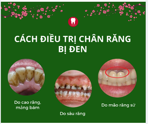 CÁCH ĐIỀU TRỊ CHÂN RĂNG BỊ ĐEN?