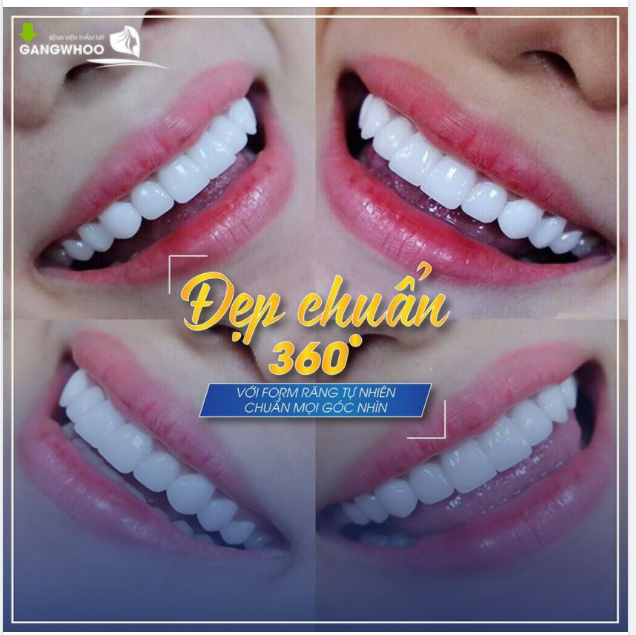 ĐẸP CHUẨN 360 ĐỘ VỚI FORM RĂNG ĐẸP TỰ NHIÊN MỌI GÓC NHÌN