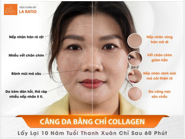 HÔ BIẾN NHĂN XỆ - Làm đầy hõm sâu bằng phương pháp căng chỉ Collagen