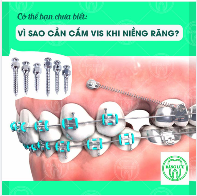 Minivis (mini vít) trong chỉnh nha