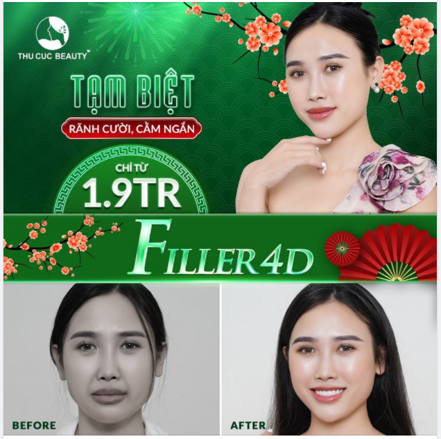 TẠM BIỆT RÃNH CƯỜI VỚI TẠO HÌNH KHÔNG PT FILLER 4D