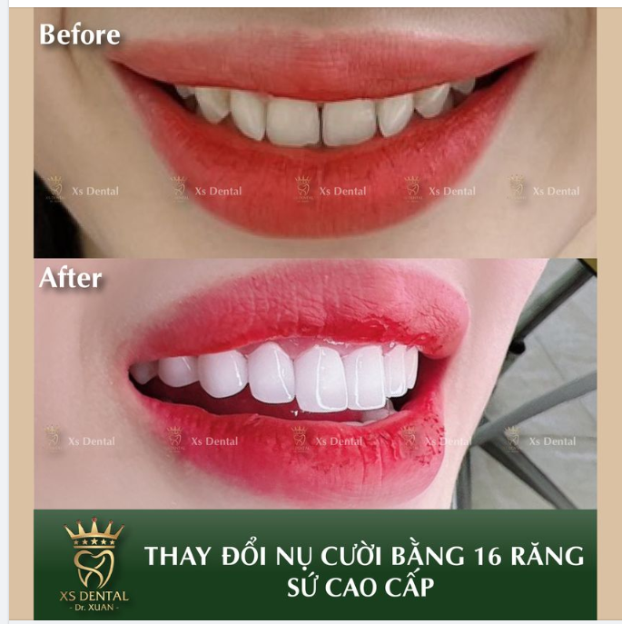 FORM RĂNG CHUẨN ĐẸP - TÁI THIẾT NỤ CƯỜI TỪ TIÊU CHUẨN THẨM MỸ THỜI THƯỢNG