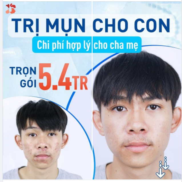 Mụn dậy thì mọc chi chít Khiến con tự ti, ảnh hưởng mọi mặt cuộc sống