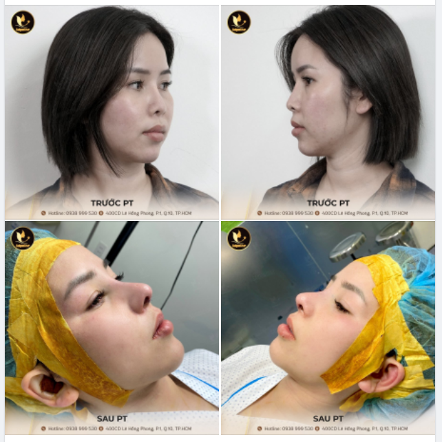 KHẮC PHỤC MŨI HỎNG LẦN 2 – KH YEN MEI TENG (VIỆT KIỀU ÚC)