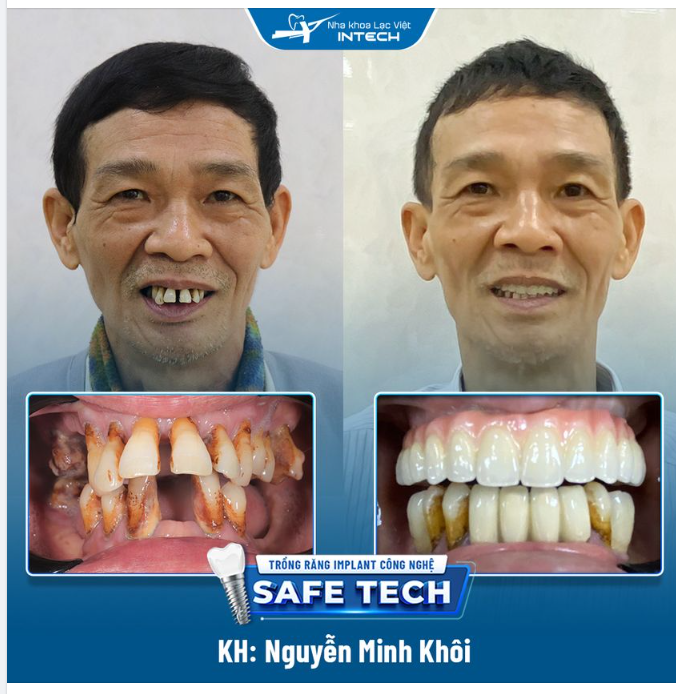 TRỒNG RĂNG IMPLANT TOÀN HÀM – RĂNG ĐỀU ĐẸP, ĂN NHAI TỐT