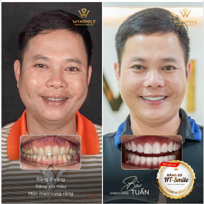 FORM RĂNG NAM TÍNH NÂNG CẤP DIỆN MẠO ĐIỂN TRAI, PHONG ĐỘ