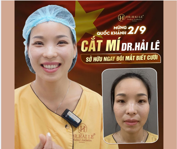 Gu của em rất đơn giản và thoải mái. Cắt mí xong xinh gái là okila