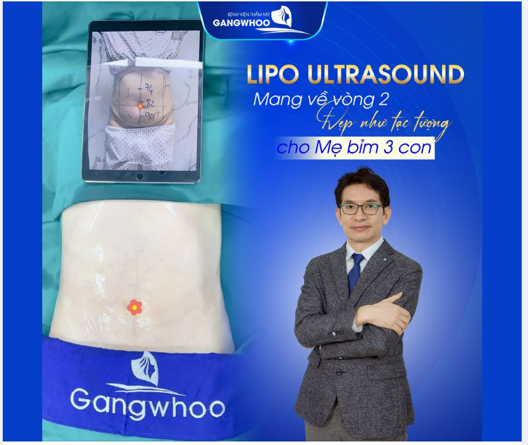 LIPO ULTRASOUND MANG VỀ VÒNG 2 ĐẸP NHƯ TẠC TƯỢNG CHO MẸ BỈM 3 CON
