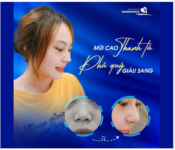NÂNG MŨI CẤU TRÚC SỤN NANO SINH HỌC - MŨI CAO TỰ NHIÊN THANH THOÁT