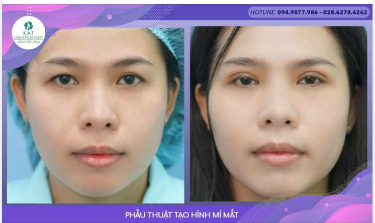 Phẫu thuật cắt mí mắt trên tại KAT đã giúp bạn tạm biệt đôi mắt không ...