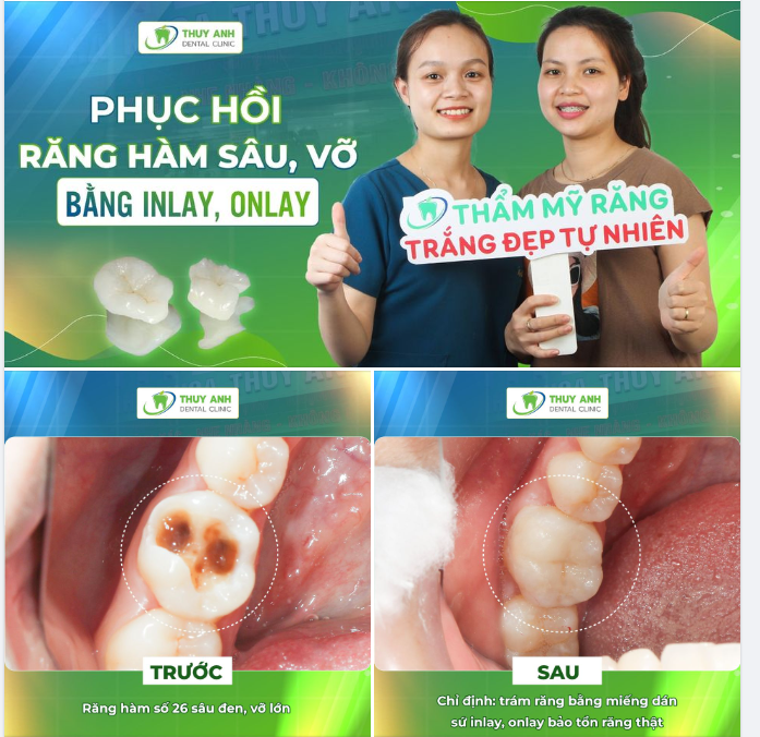 TẠM BIỆT RĂNG SÂU BẰNG MẶT DÁN SỨ INLAY/ONLAY
