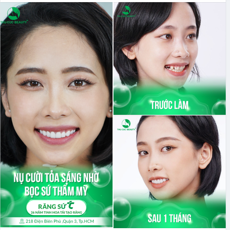 Bọc răng sứ xong khiến mọi người đều tấm tắc khen đáng ra nên làm sớm ...