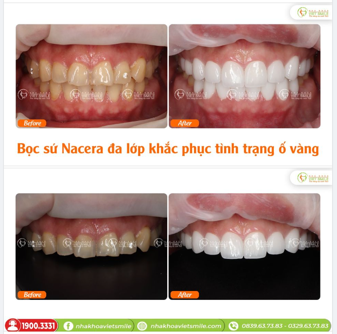BỌC SỨ NACERA ĐA LỚP KHẮC PHỤC TÌNH TRẠNG Ố VÀNG