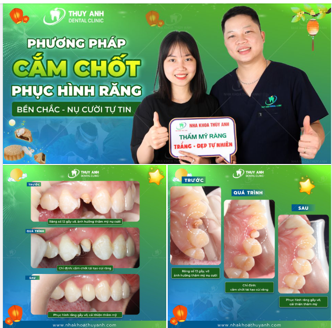 CẮM CHỐT BẢO TỒN RĂNG THẬT, TIẾT KIỆM - HIỆU QUẢ - BỀN LÂU