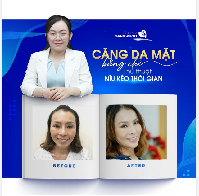 CĂNG DA MẶT BẰNG CHỈ COLLAGEN THỦ THUẬT NÍU KÉO THỜI GIAN