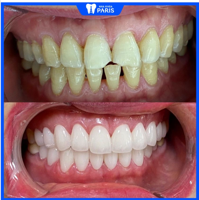 "KHOÁC BỘ ÁO MỚI" ÁNH KIM CƯƠNG CHO CA RĂNG NHIỄM KHÁNG SINH NẶNG