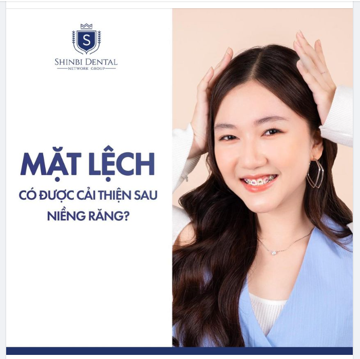 MẶT LỆCH CÓ ĐƯỢC CẢI THIỆN SAU NIỀNG RĂNG