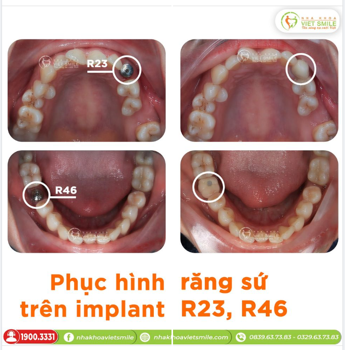 PHỤC HÌNH RĂNG SỨ TRÊN TRỤ IMPLANT RĂNG 23, RĂNG 46