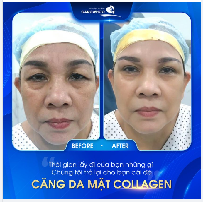 QUY TRÌNH CĂNG DA MẶT BẰNG CHỈ COLLAGEN TẠI BVTM GANGWHOO: