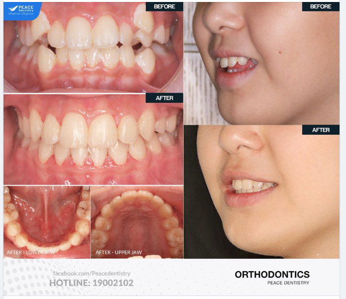 RĂNG ĐỀU ĐẸP HƠN NHỜ CHỈNH NHA