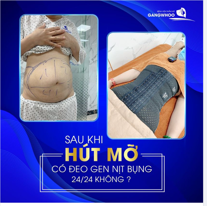 SAU KHI GIẢM MỠ CÓ CẦN MANG GEN NỊT BỤNG LIÊN TỤC KHÔNG?