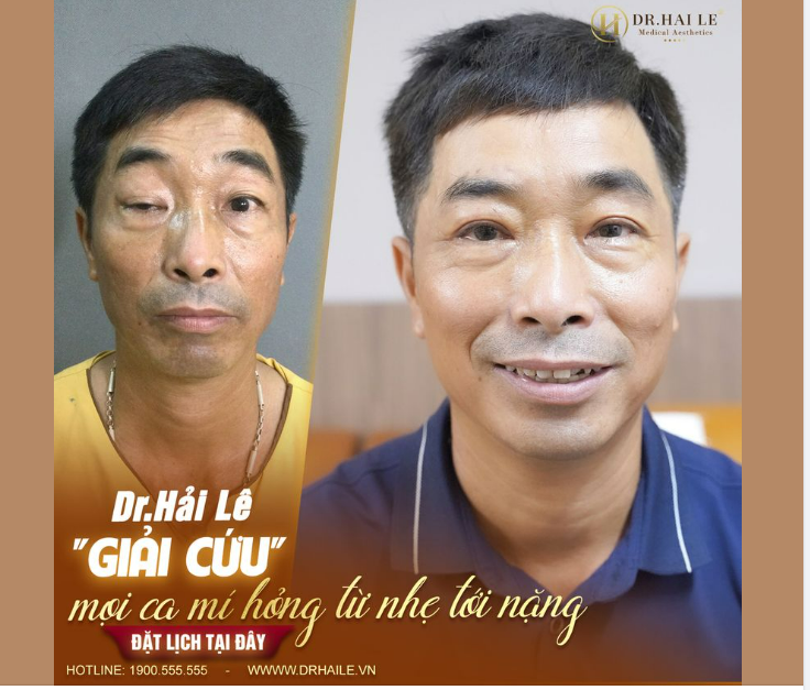 47 năm sống trong mặc cảm, tự ti vì sụp mí bẩm sinh, mắt "con đậu con bay"