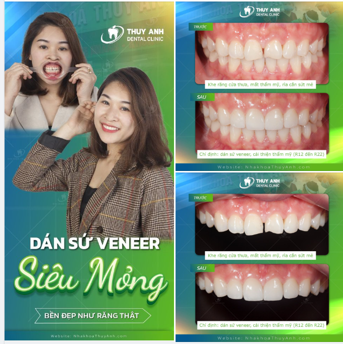 BẤT NGỜ VỚI HÌNH ️ẢNH MỚI CỦA CHỊ HƯỜNG SAU DÁN SỨ VENEER