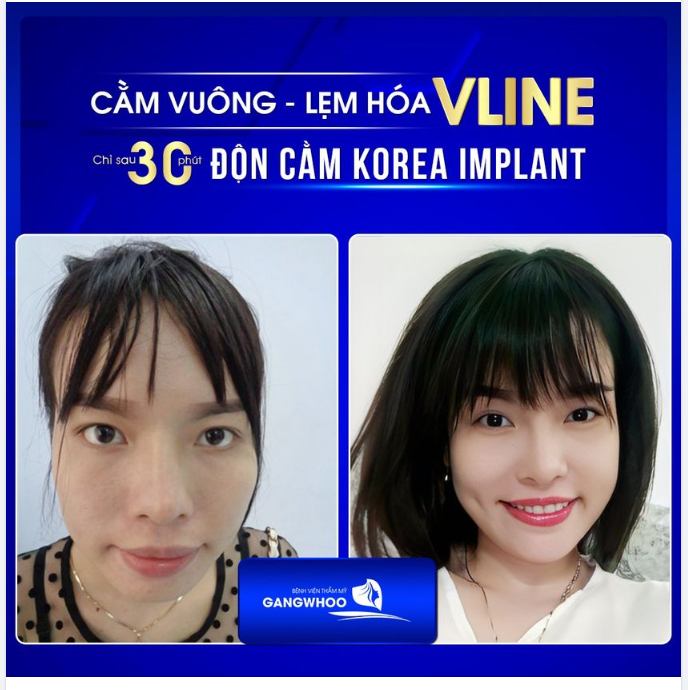 CẰM VUÔNG - LẸM HÓA VLINE CHỈ SAU 30 PHÚT ĐỘN CẰM KOREA IMPLANT