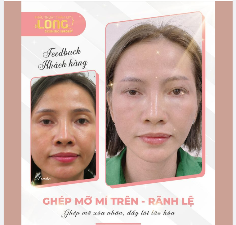 Có bao giờ bạn nghĩ đến ĐÔI MẮT ảnh hưởng rất nhiều đến thẩm mỹ khuôn mặt