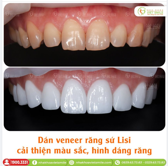 DÁN VENEER 20 RĂNG SỨ LISI PRESS THỦ CÔNG THẨM MỸ NỤ CƯỜI, ĐÓNG KHE THƯA