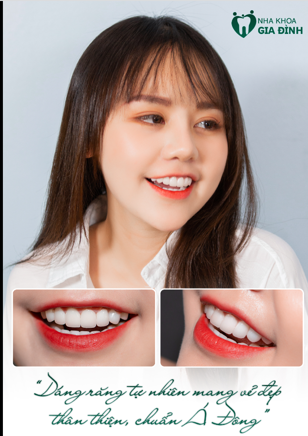 DÁNG RĂNG TỰ NHIÊN MANG VẺ ĐẸP CHUẨN Á ĐÔNG