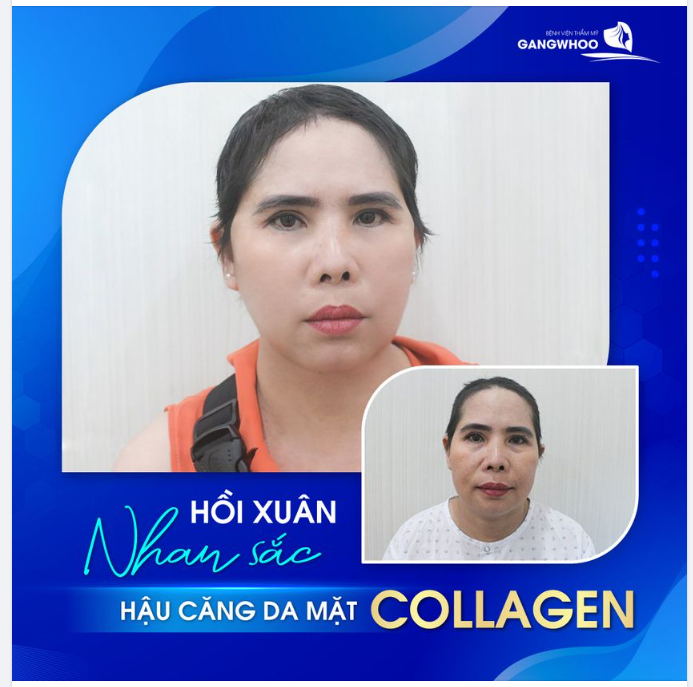 HỒI XUÂN NHAN SẮC HẬU CĂNG DA MẶT BẰNG CHỈ COLLAGEN