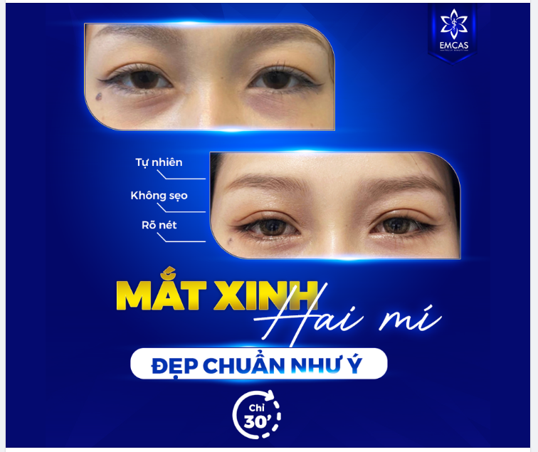 MẮT XINH HAI MÍ - ĐẸP CHUẨN NHƯ Ý
