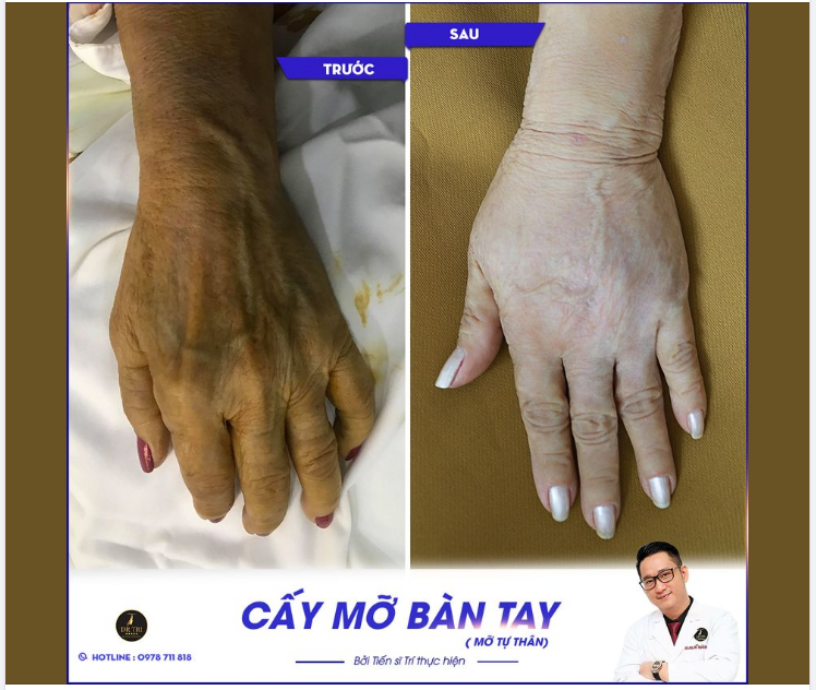 MỘT BÀN TAY ĐẸP SAU KHI CẤY MỠ GỒM CÁC ĐẶC ĐIỂM SAU