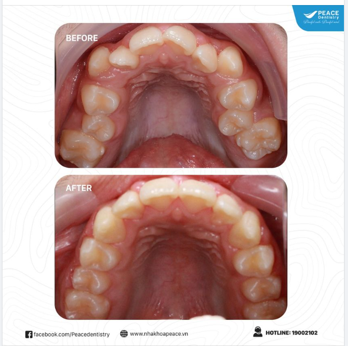 Niềng răng khấp khểnh, không chỉ giúp bạn sở hữu hàm răng đều đặn mà ...