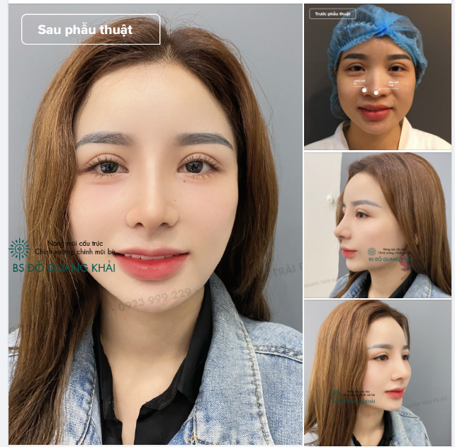 NÂNG MŨI CẤU TRÚC CHỈ VỚI 40TR