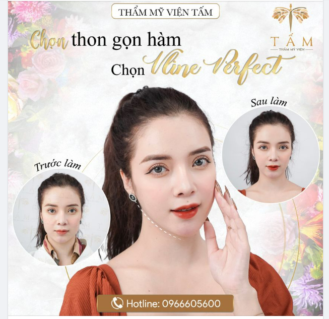 V-line Perfect - Liệu pháp hiệu quả cho gương mặt O-line