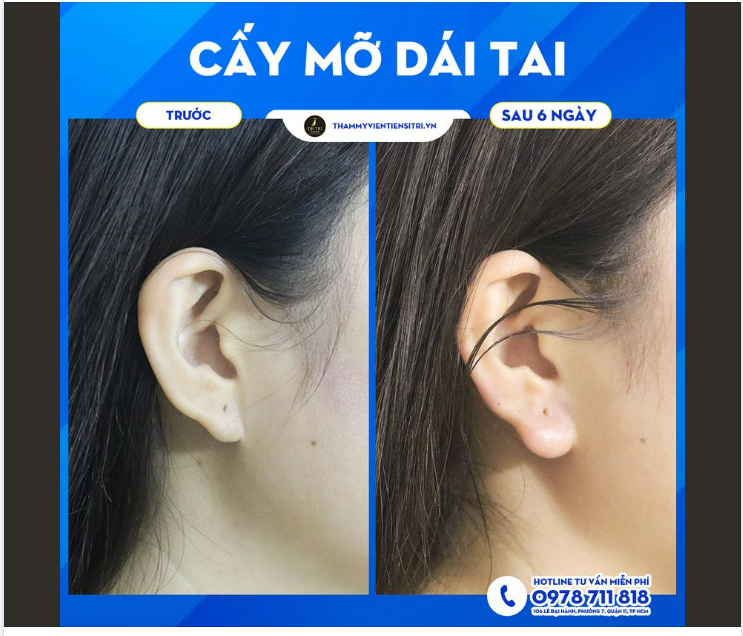 Hình ảnh dáng Tai tài lộc nhờ cấy mỡ tự thân