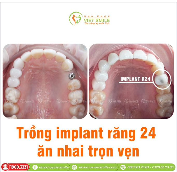 TRỒNG IMPLANT RĂNG 24 ĂN NHAI TRỌN VẸN