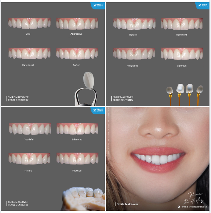 Chọn form răng khi làm thẩm mỹ răng sứ