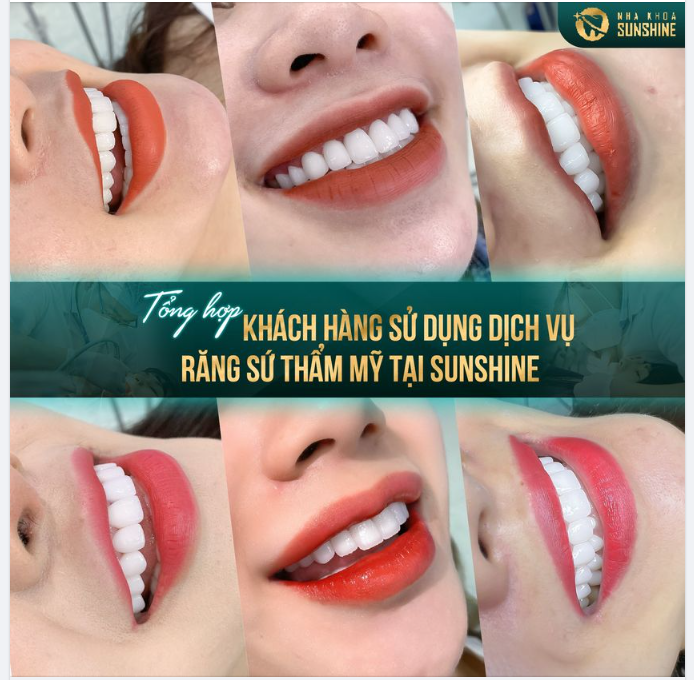 Để có được một nụ cười tỷ lệ hài hoà với khuôn mặt, một hàm răng trắng ...