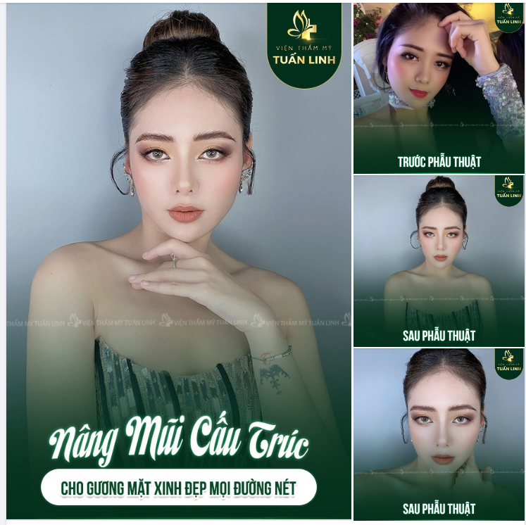 GƯƠNG MẶT XINH ĐẸP SẮC NÉT THÌ KHÔNG THỂ THIẾU MỘT CHIẾC MŨI CAO XINH