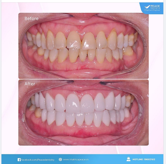 Một nụ cười đẹp, form răng và màu răng phù hợp với chính bạn, đảm bảo ...