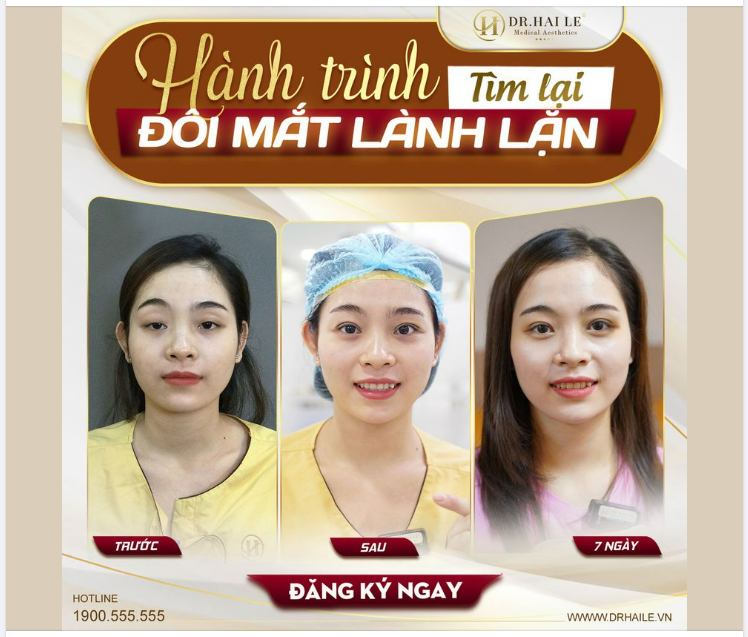 Nhật ký Cắt mí sụp bẩm sinh của cô gái 25 năm sở hữu gương mặt xinh đẹp ...