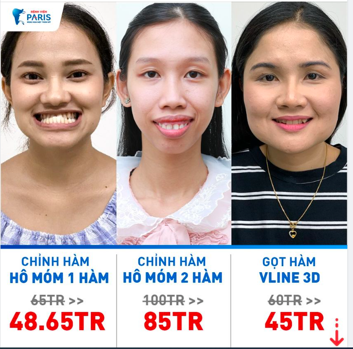 PHẪU THUẬT HÔ MÓM GIÁ TỐT NHẤT NĂM