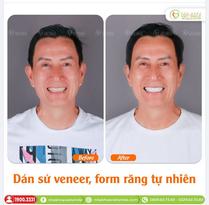 DÁN SỨ VENEER VỚI FORM RĂNG TỰ NHIÊN